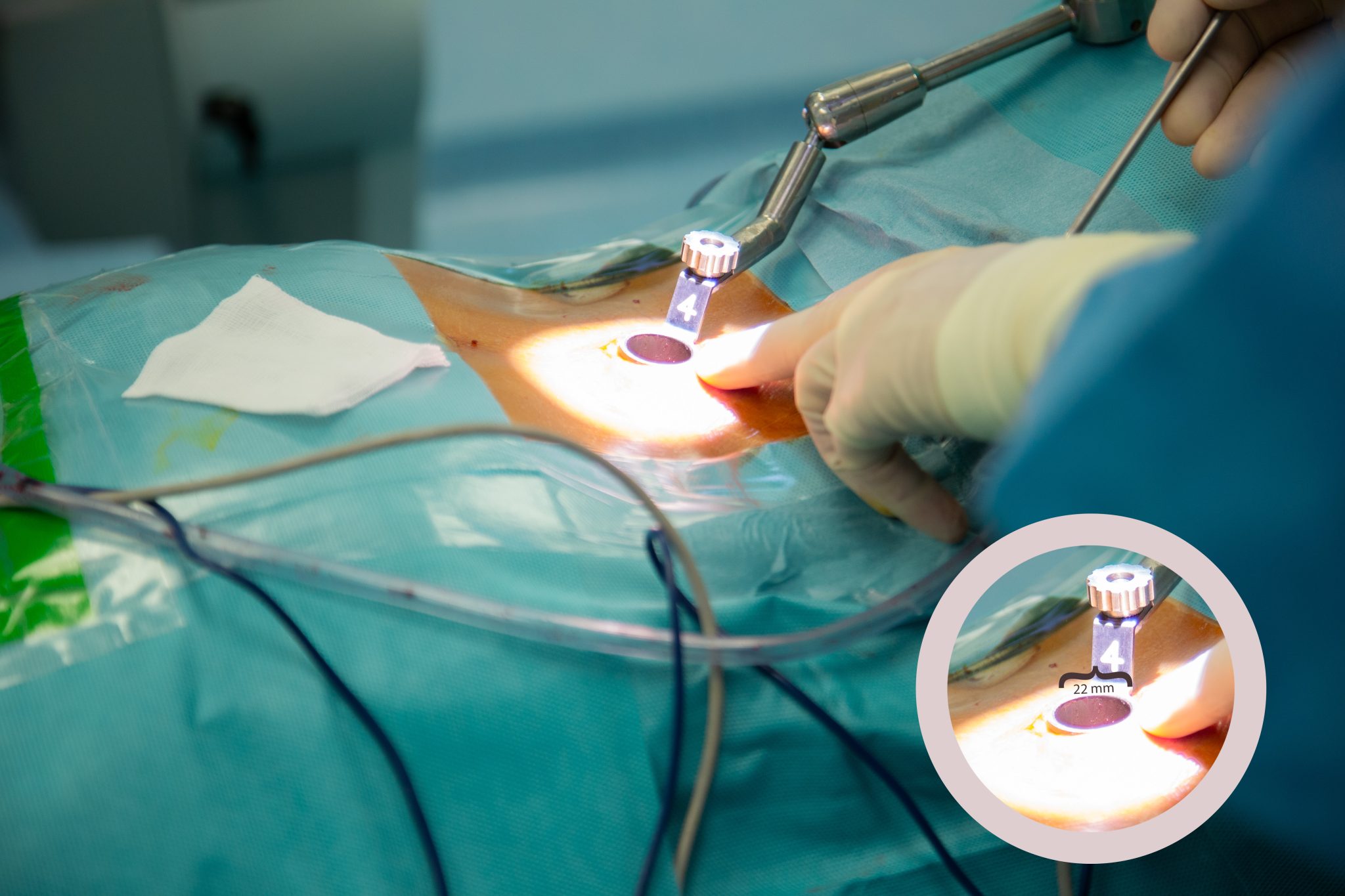 Microdiscectomia lombară, cervicală posterioară sau toracală